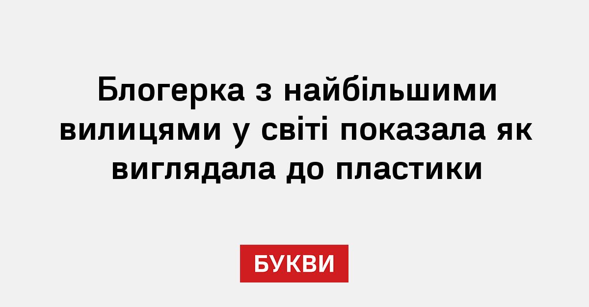 Блогерка з найбільшими вилицями у світі показала як виглядала до